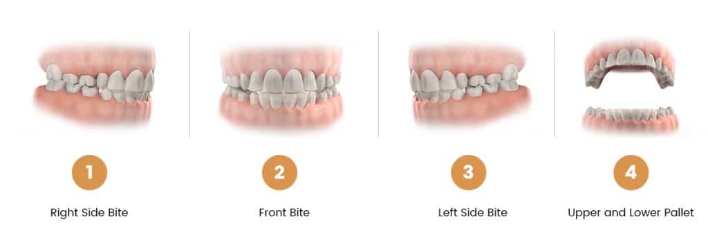Dental Crowns – Creative Smiles Turkey
