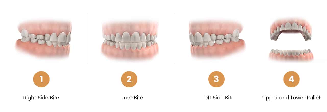 Dental Crowns – Creative Smiles Turkey