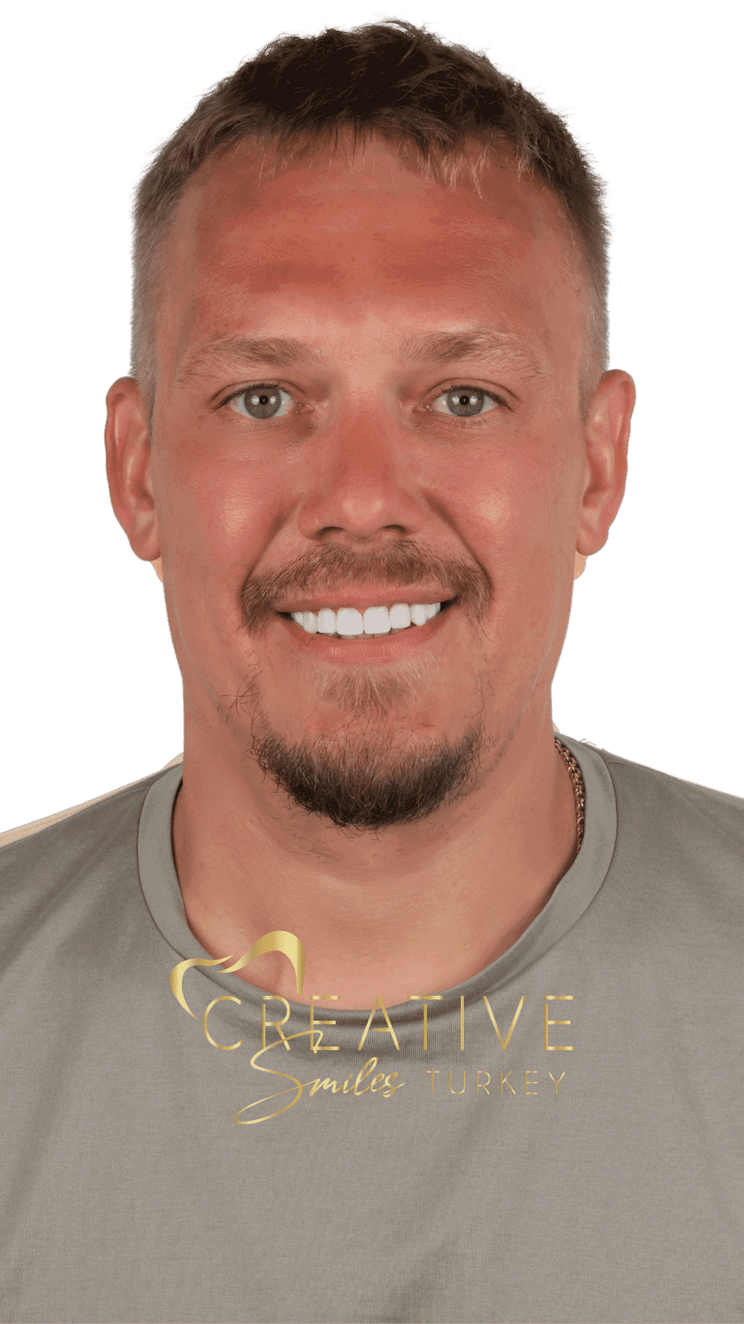 Smile Gallery – Creative Smiles Turkey