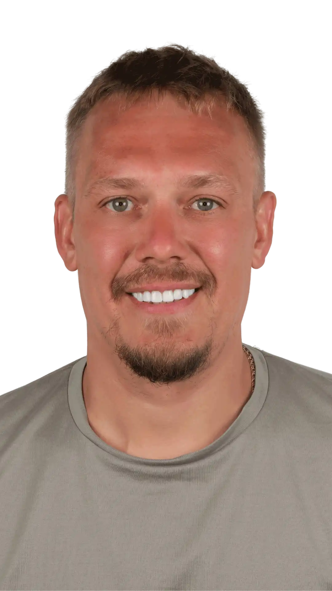 Composite Bonding – Creative Smiles Turkey