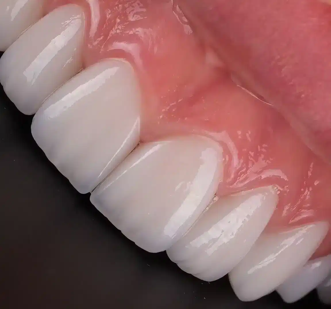 Laminate Veneer – Creative Smiles Turkey